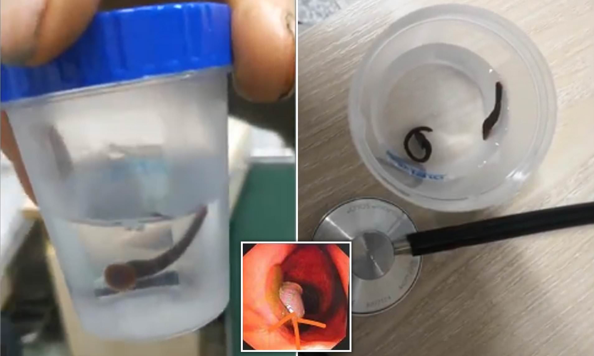 Chinese Man Has 2 Live Leeches Removed From His Nose And Throat After ...