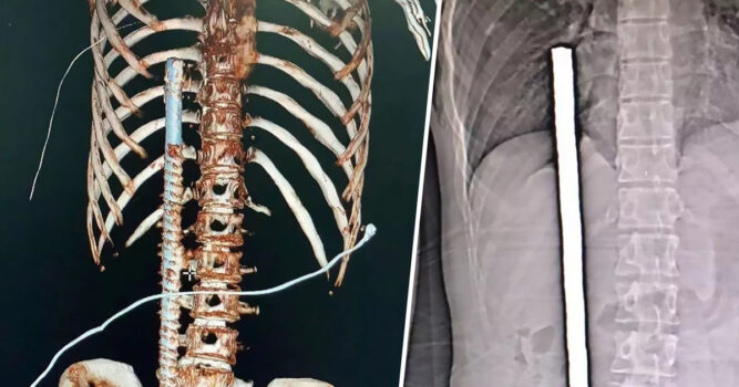 Construction Worker Escapes Death After Bum Gets Impaled By Metal Rod ...