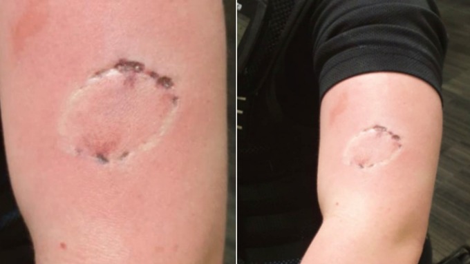 Hardworking Police Officer Left With Teeth Marks On Arm After Being Bitten
