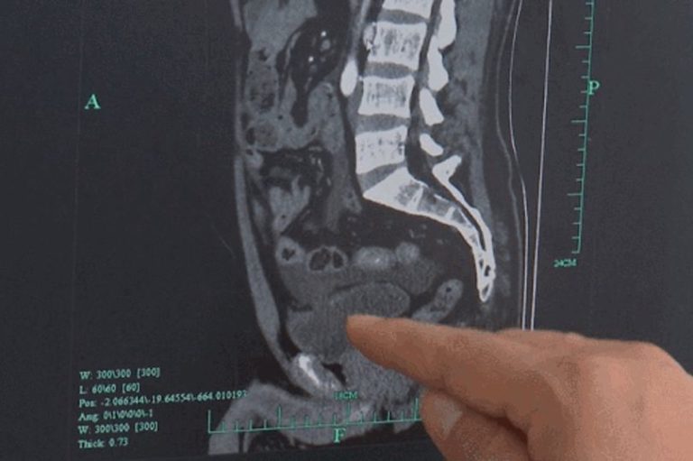 Man’s Bladder Explodes After Holding His Pee For 18 Hours Following A ...