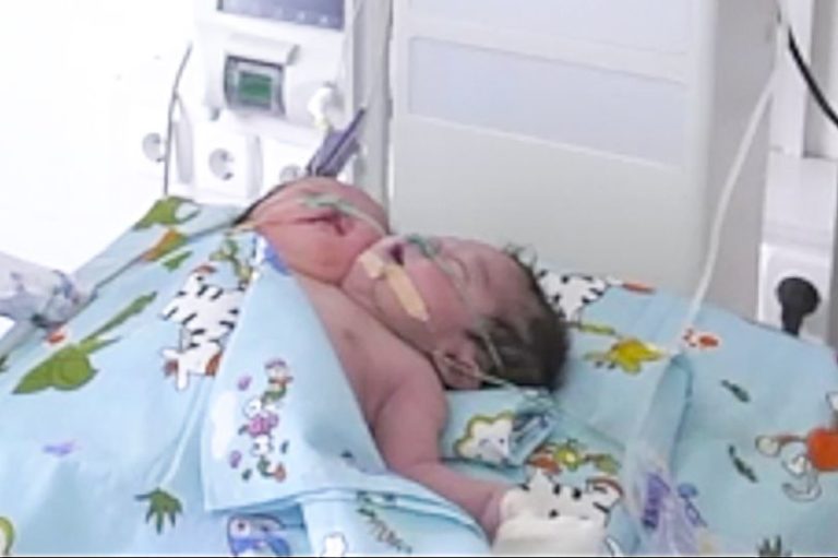 2-Headed Baby Born With 2 Sets Of Organs Fight For Survival In ...