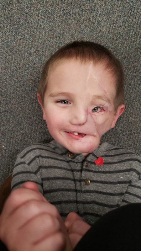 5-Year-Old Boy Left With Disfigured Face After Horrible Dog Attack At ...