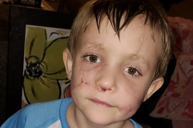 6-Year-Old Gets Face Ripped Apart By “Lovable” Family Dog When Mother ...